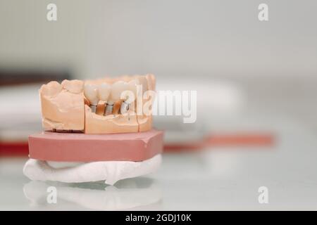 Dental layout of the human jaw with teeth and implants Stock Photo - Alamy