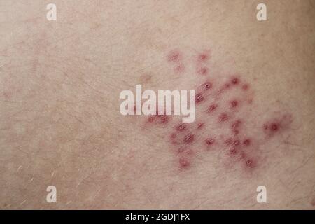 Shingles rash of blisters on the skin of the leg in an 85 year old male ...