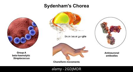 Sydenham's chorea, illustration Stock Photo - Alamy