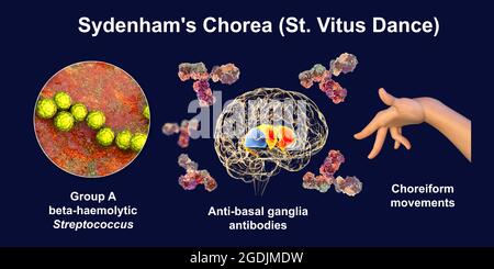 Sydenham's chorea, illustration Stock Photo - Alamy