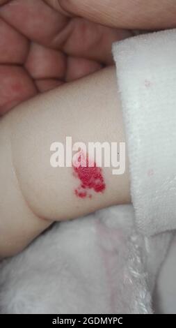 Hemangioma red birthmark on the leg of newborn baby Stock Photo - Alamy