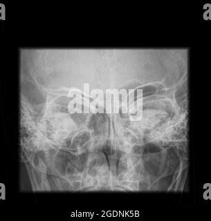 Radiography of a human skull paranasal sinuses rhinosinusitis ...