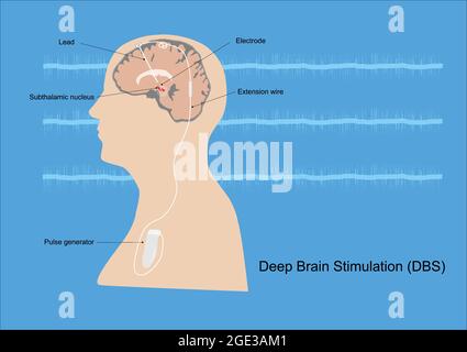 Deep brain stimulation at subthalamic nucleus for treatment of ...