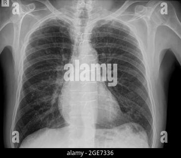 Chest radiography, lung x-ray after a covid 19 infection Stock Photo ...