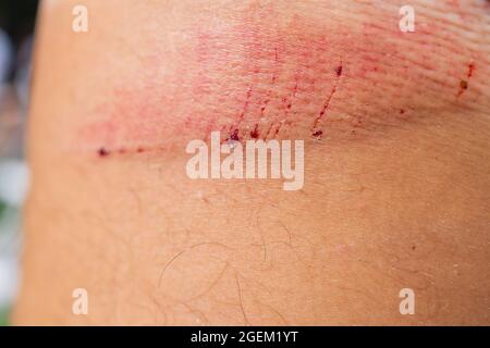 scratch lesion caused by the accident on leg skin Stock Photo - Alamy