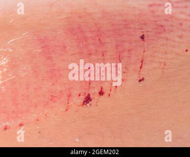 scratch lesion caused by the accident on leg skin Stock Photo - Alamy