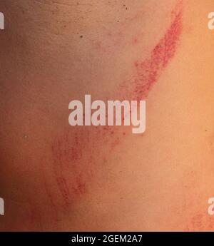 scratch lesion caused by the accident on leg skin Stock Photo - Alamy