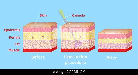 Mechanism of liposuction. Suction-assisted liposuction. Hollow tube or ...