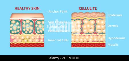 Forming of underskin cellulite illustration. Structure of normal ...