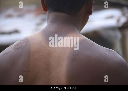 Extra sun-scorched shoulders and neck skin, The body part between the ...