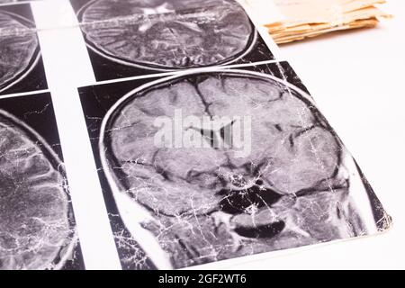 MRI image of the brain on paper close up Stock Photo - Alamy