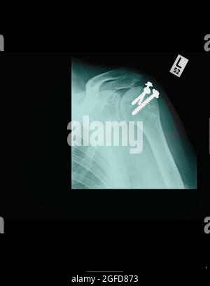 Coloured X-ray of the shoulder joint of a patient aged 51, showing the ...