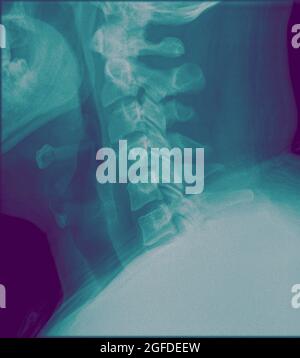 Side view of a Human head, neck, and upper chest CT scan showing the ...