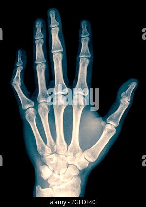x-ray of wrist, hand and fingers of a 34 year old male patient with a ...