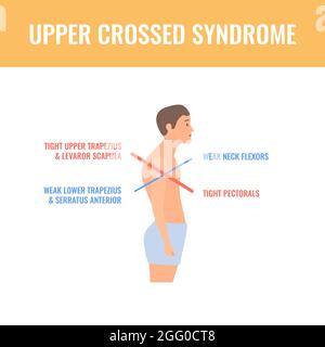 Upper crossed syndrome, conceptual illustration Stock Photo - Alamy