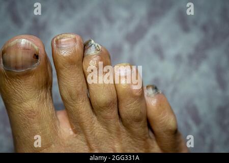 Onychomycosis toenail fungus disease infection on mans toes coursing ...