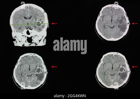 A CT brain scan of a patient with large brain abscesses in her left ...