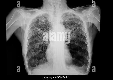 Pulmonary Tuberculosis ( TB ) : Chest x-ray show alveolar infiltration ...