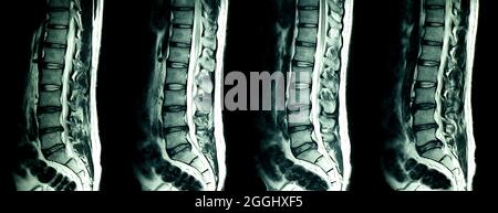 MRI scan of lumbar spines of a patient with chronic back pain showing ...