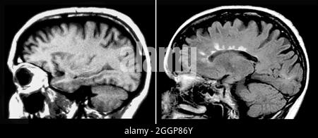MRI of Normal Brain and Multiple Sclerosis Lesions Stock Photo - Alamy