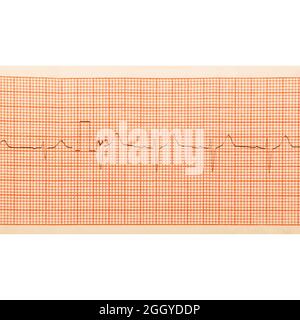ECG test results on millimeter paper, heart rhythm results, close up of ...