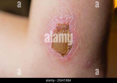 scratch lesion caused by the accident on leg skin Stock Photo - Alamy