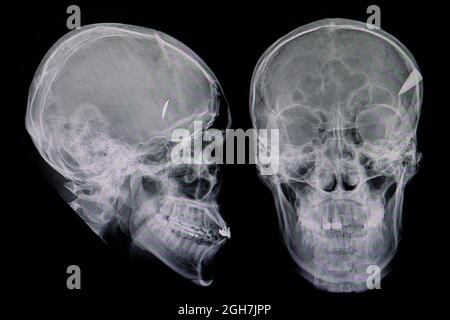 lateral skull x-ray Stock Photo - Alamy