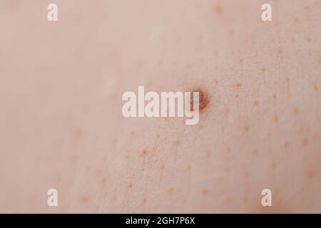 Human skin with mole, closeup Stock Photo - Alamy