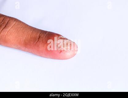 Fungal infection (tinea). Fingernail damaged by a fungal infection ...