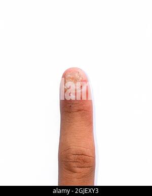 Fungal infection (tinea). Fingernail damaged by a fungal infection ...
