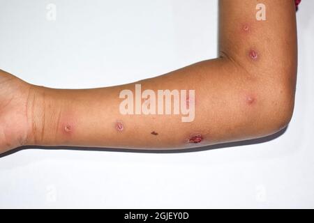 Scabies Infestation with secondary or superimposed bacterial infection ...
