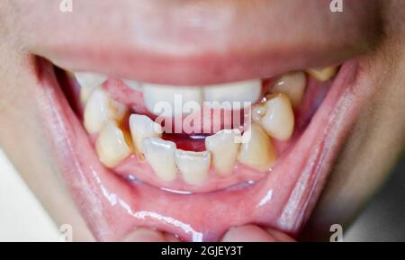 Stacked or overlapping canine teeth of Asian man. Also called crowded ...