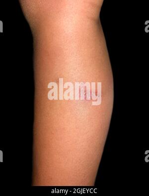Furuncles or staphylococcal infection in leg of Asian child. Also ...