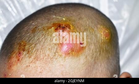 Carbuncles or staphylococcal infection in head of Asian child. Painful ...