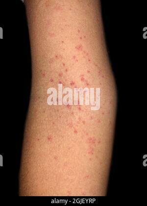 Multiple red spots in cubital fossa showing that Hess’s test positive ...