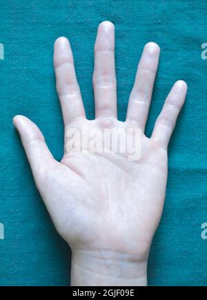 Pale palmar surface of both hands. Anaemic hands of Asian, Chinese ...