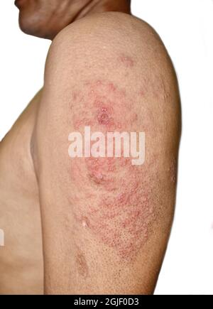 Herpes simplex infection at arm of Asian young man. Small and painful ...