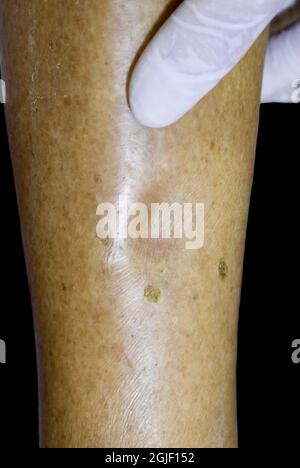 Bilateral swelling of the lower limbs (legs, ankles and feet) due to ...