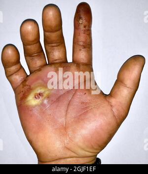 Large abscess with surrounding cellulitis or Staphylococcal ...