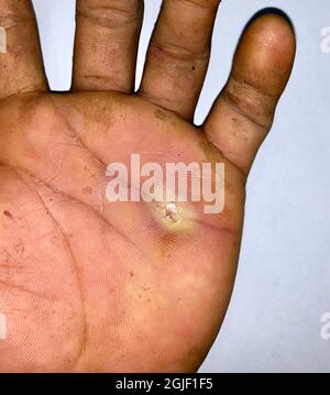 abscess with surrounding cellulitis or Staphylococcal / Streptococcal ...