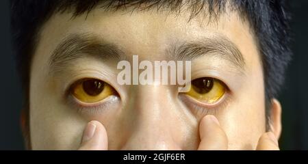 Jaundice alcoholic liver disease Stock Photo - Alamy