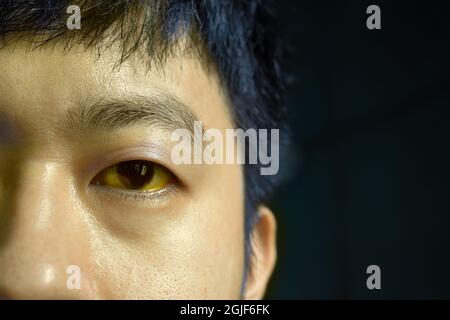Deep jaundice in Asian male patient. Yellowish discoloration of skin ...