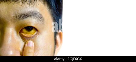 Deep jaundice in Asian male patient. Yellowish discoloration of skin ...