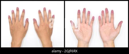 Cyanotic hands or peripheral cyanosis or blue hands at Southeast Asian ...
