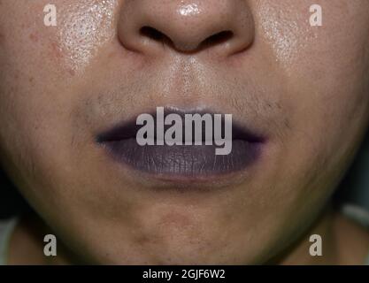 Cyanotic lips or central cyanosis at Southeast Asian elder man with ...