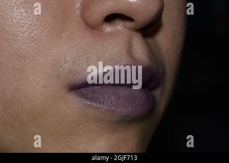 Cyanotic lips or central cyanosis at Southeast Asian old woman with ...