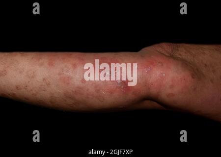 CELLULITIS ON LEG Stock Photo - Alamy