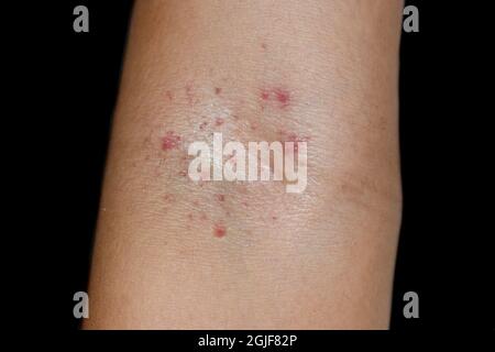 Petechiae On Arms