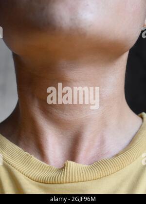 Neck swelling diagnosed as hyperthyroidism. Aging skin folds or skin ...