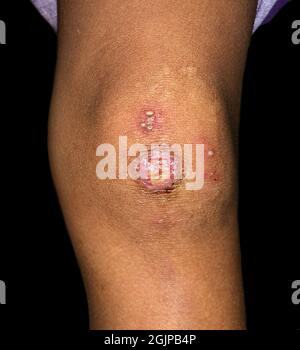 Furuncles or staphylococcal infection in leg of Asian child. Also ...